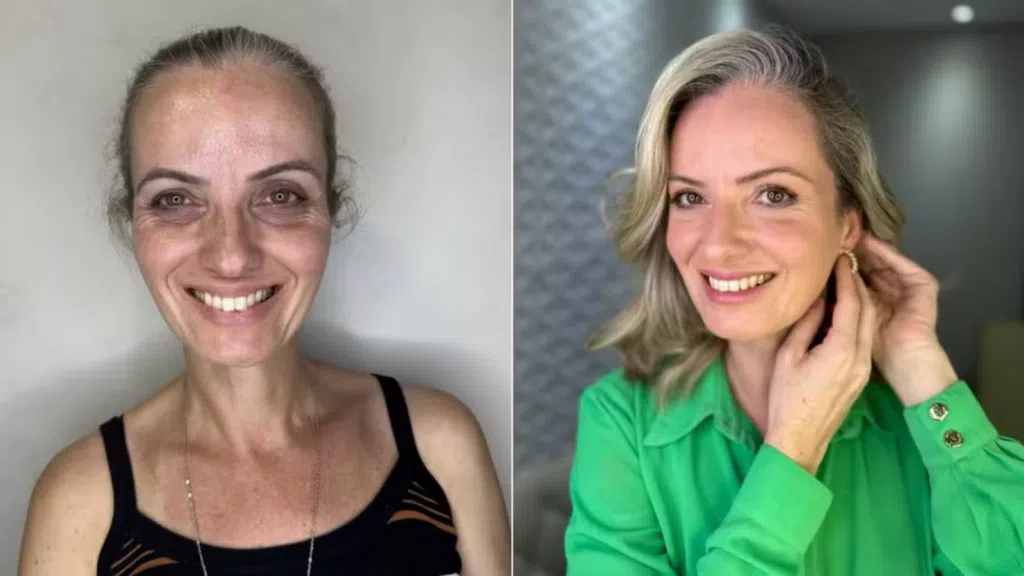 O que é peeling de fenol?