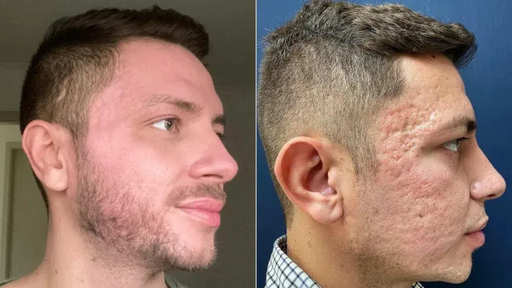 O que é peeling de fenol?